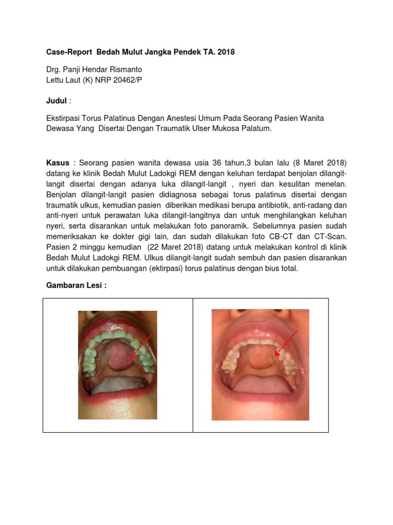 EKSTIRPASI TORUS PALATINUS YANG DISERTAI ULKUS TRAUMATIK MUKOSA PALATAL | PDF