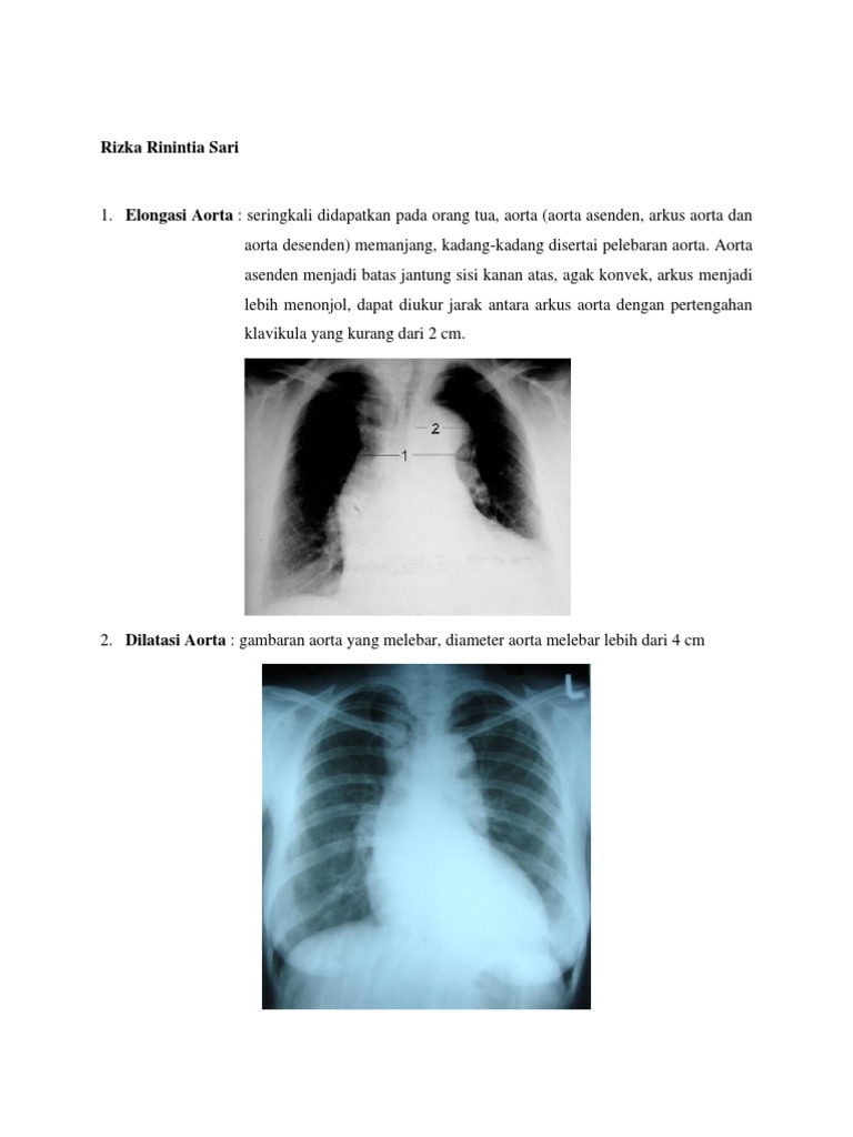 Elongasi Aorta | PDF