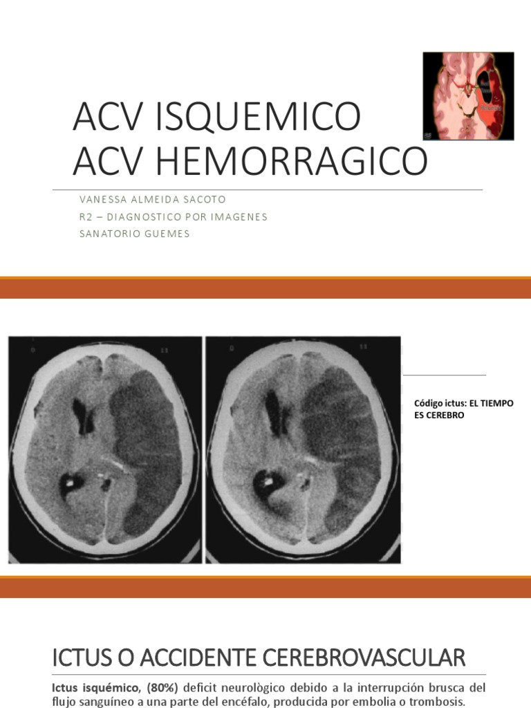 Acv Isquemico Vs Hemorragico | PDF | Carrera | Angiología