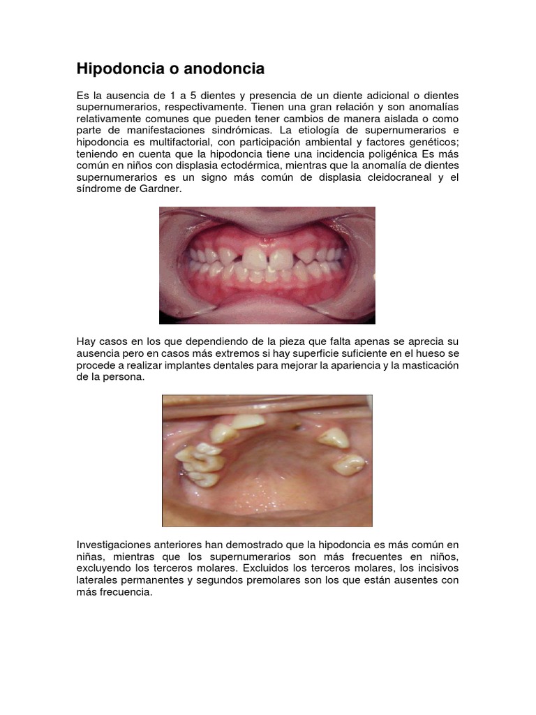 Hipodoncia o Anodoncia | PDF