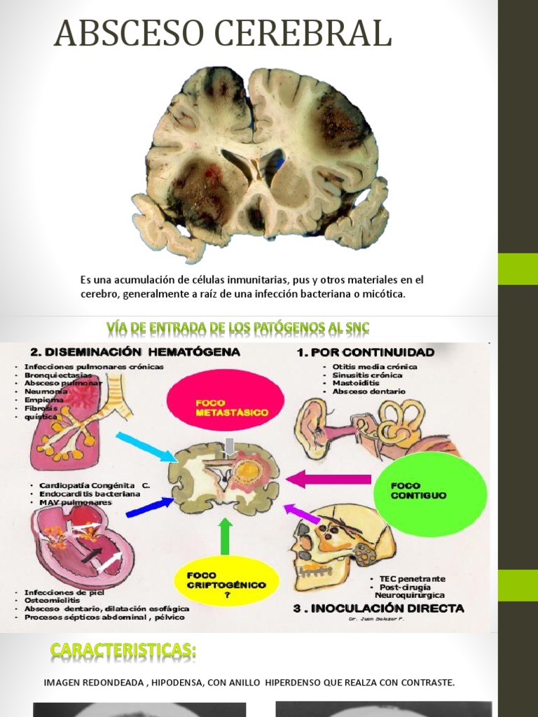 Absceso Cerebral en Tomografía Cerebral (TC) | PDF | Neurología ...