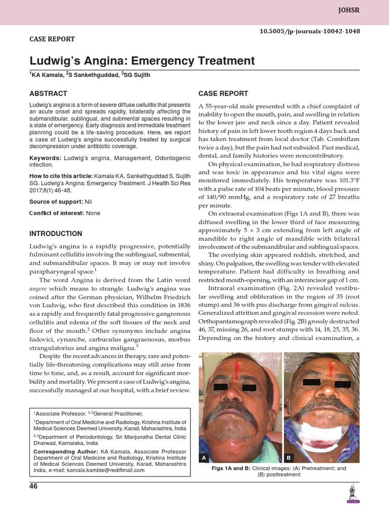 Ludwigs Angina - Emergency Treatment | PDF | Medical Specialties ...