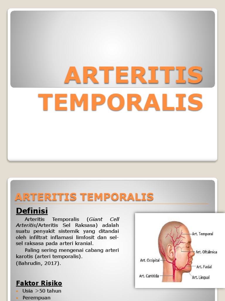 Arteritis Temporalis | PDF