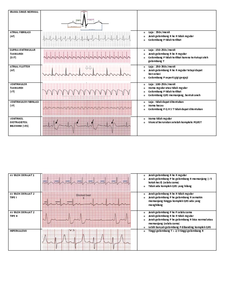 Irama Jantung Normal dan Abnormal | PDF