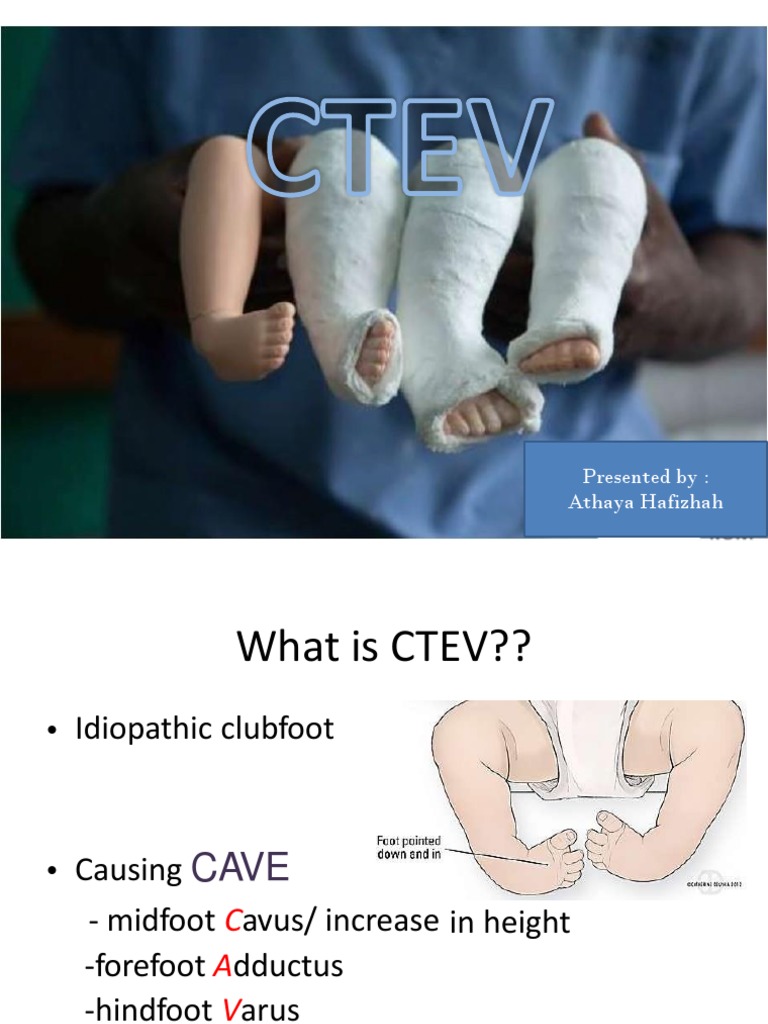 CTEV | PDF | Diseases And Disorders | Congenital Disorder