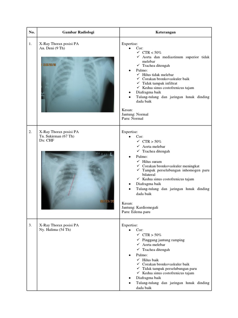 Hasil Rontgen Thorax dan Diagnosis TB | PDF