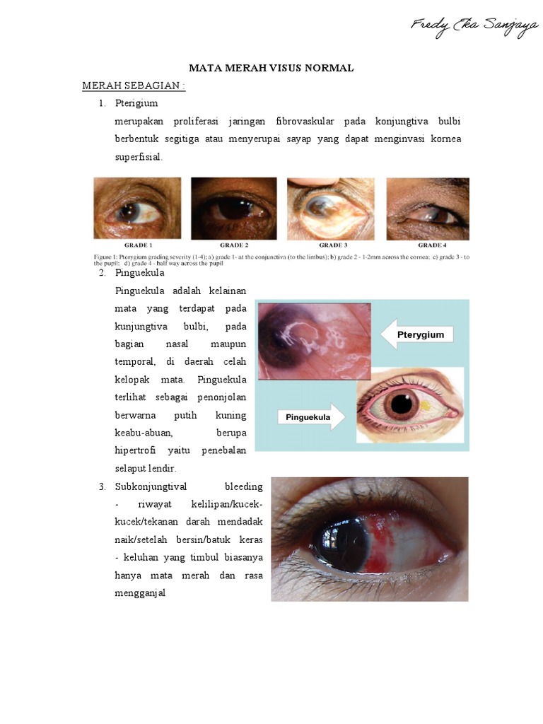 Mata Merah Visus Normal | PDF