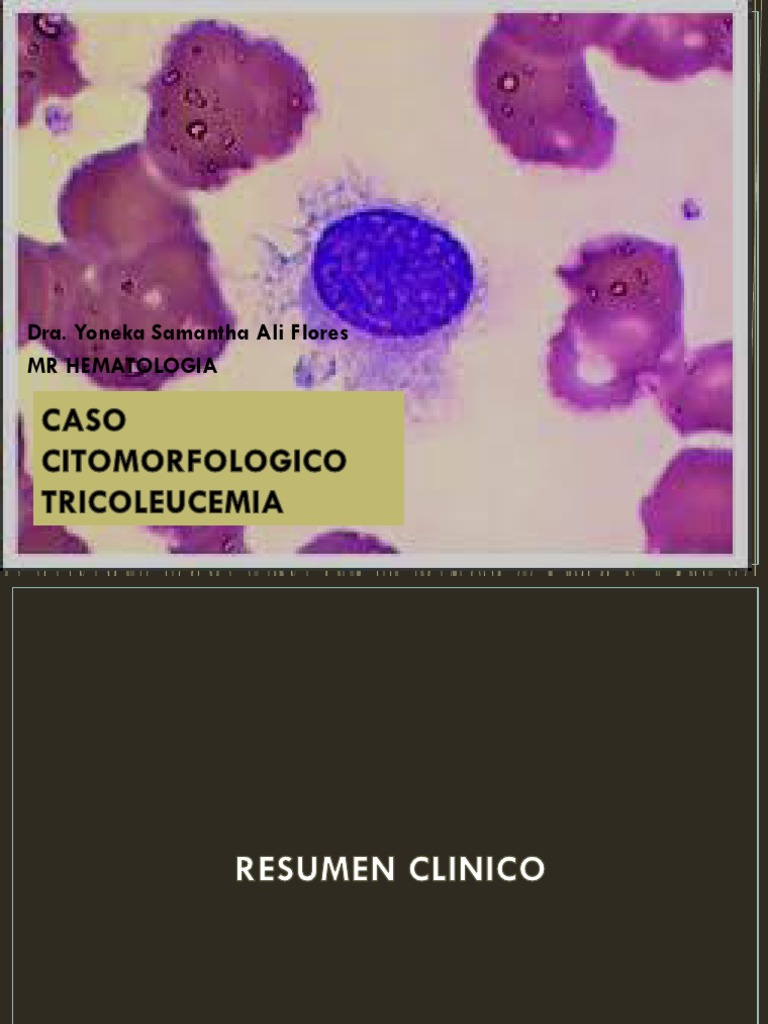 Tricoleucemia: Análisis Clínico | PDF | Linfocitos | Leucemia
