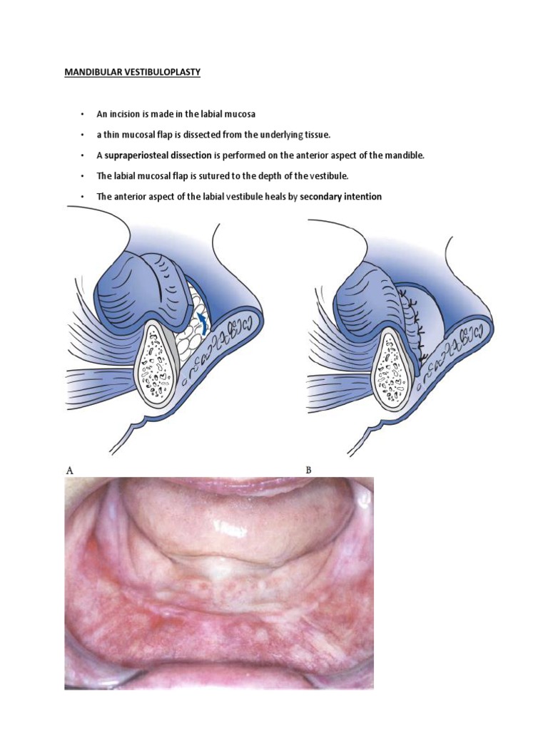 Mandibular Vestibuloplasty Procedure | PDF