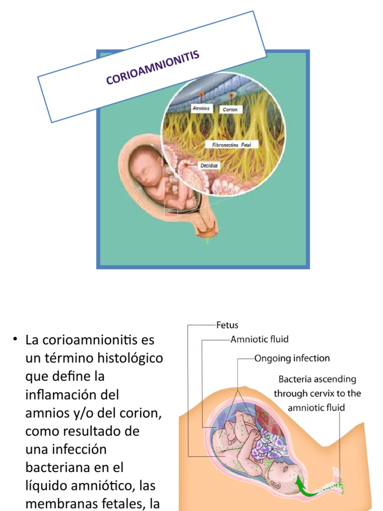 Corioamnionitis | PDF | Parto | Placenta