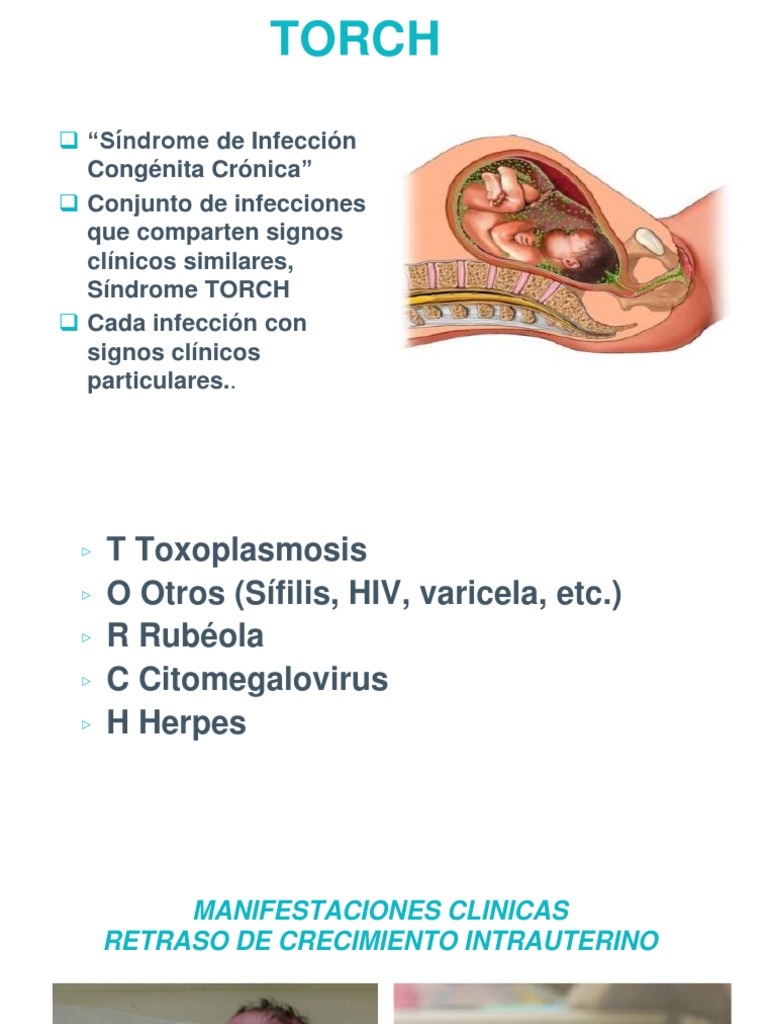 Torch | PDF | Virus | Inmunología