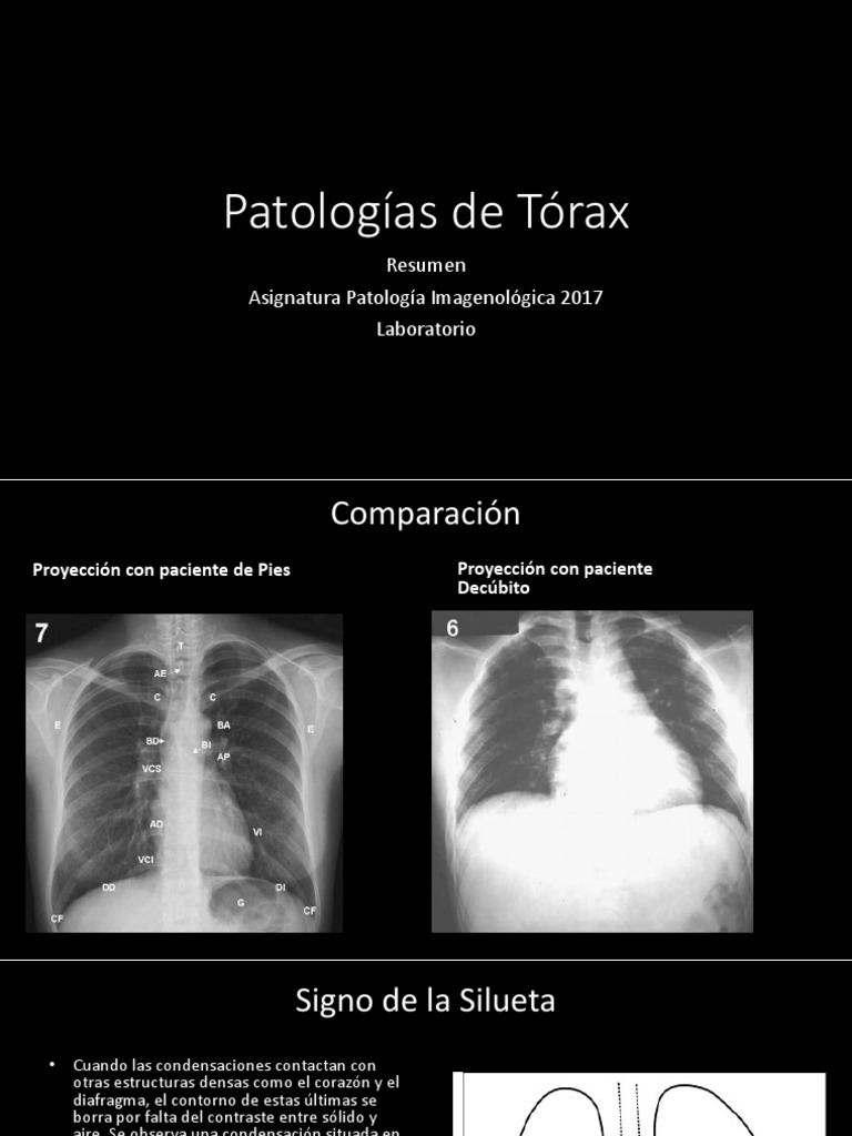 Patologias Torax RX | PDF | Pulmón | Tuberculosis