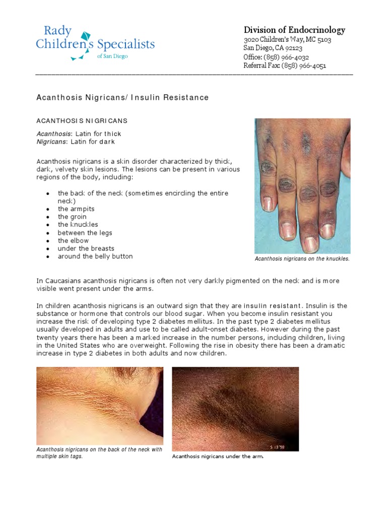 Acanthosis Nigricans | PDF | Body Mass Index | Endocrine
