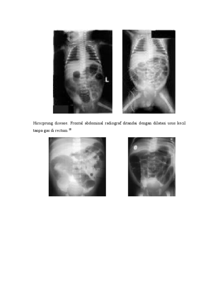 Hisprung Disease | PDF