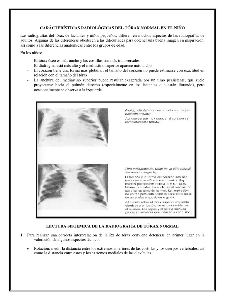 Carácterísticas Radiológicas Del Tórax Normal en El Niño | PDF | Tórax ...
