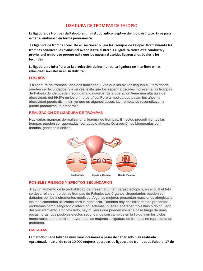 Ligadura de Trompas de Falopio | PDF | Control de la natalidad ...