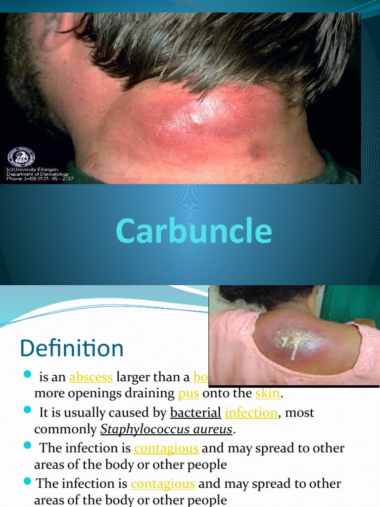 Carbuncle | Download Free PDF | Psoriasis | Epidermis