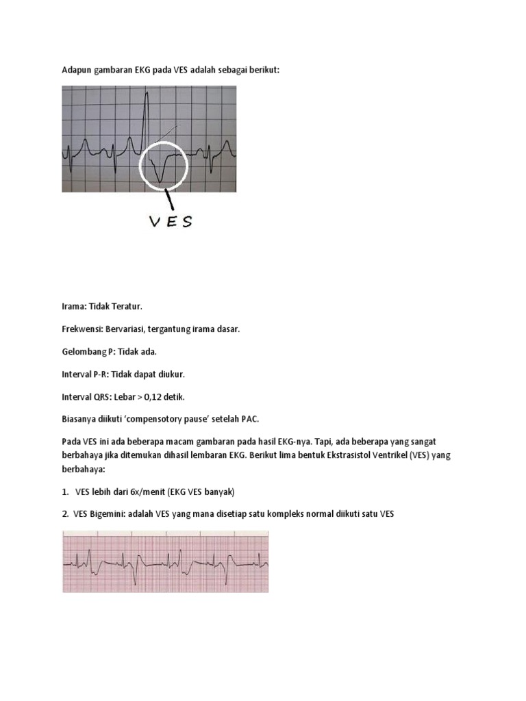 Adapun Gambaran EKG Pada VES Adalah Sebagai Berikut | PDF