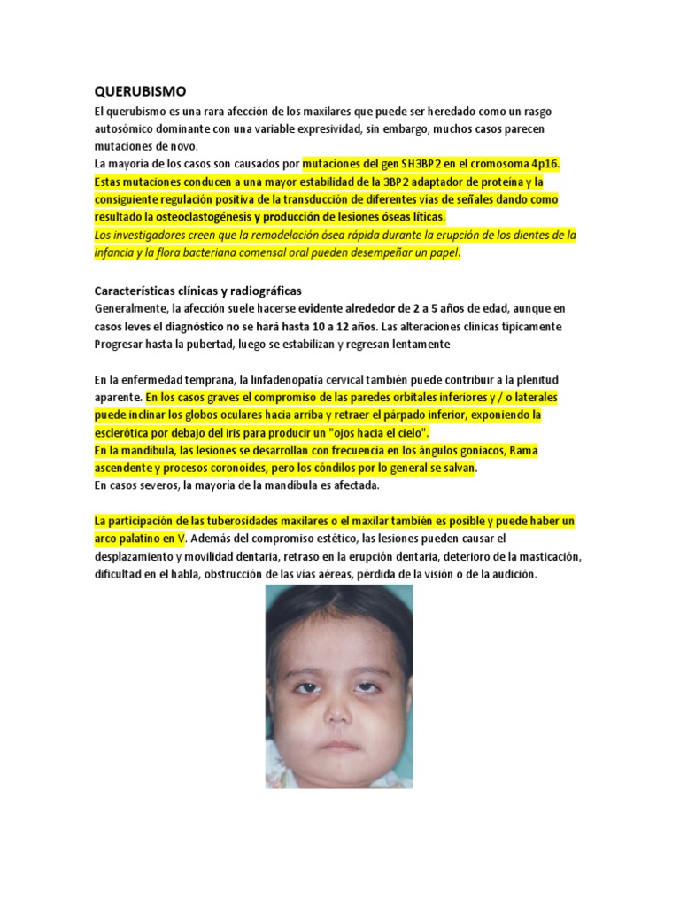 Síndrome de Querubismo: Causas y Tratamiento | PDF | Mutación | Hueso