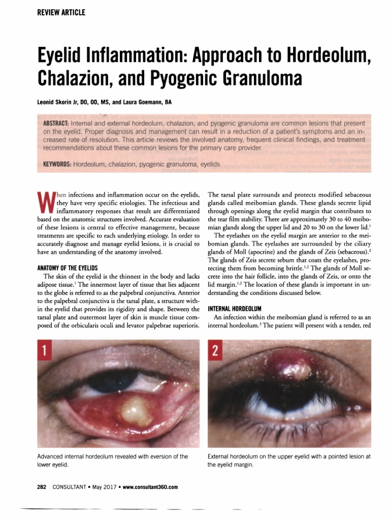 Pyogenic Granuloma Eye Treatment
