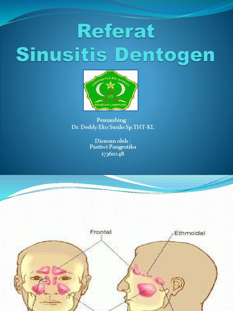 Sinus Maksila: Anatomi dan Sinusitis | PDF