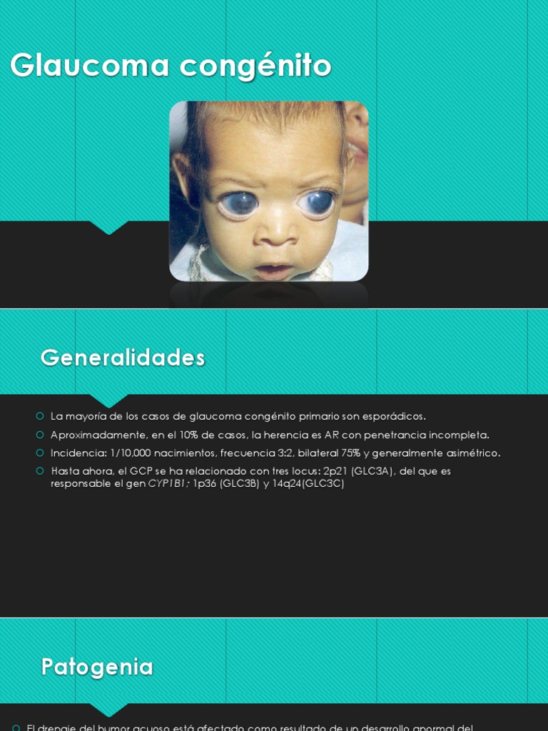 Glaucoma Congenito Primario | PDF | Glaucoma | Córnea