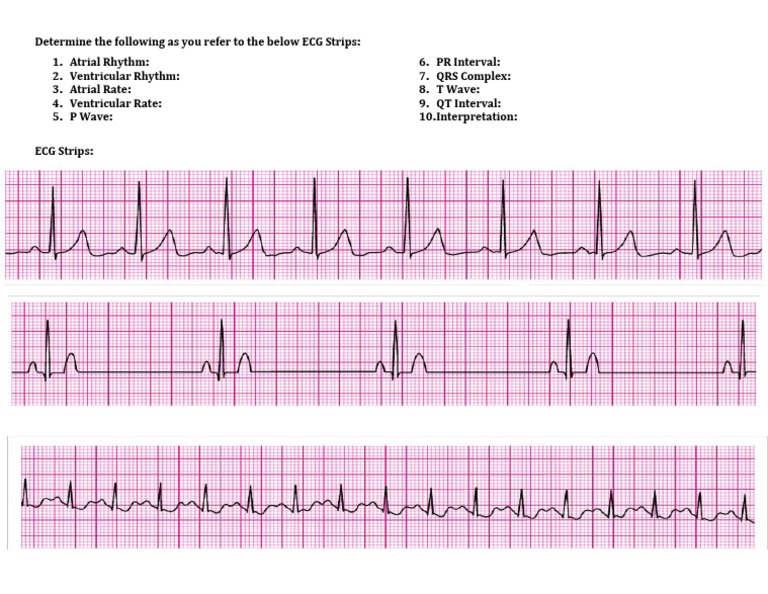 Ecg Practice Test | PDF
