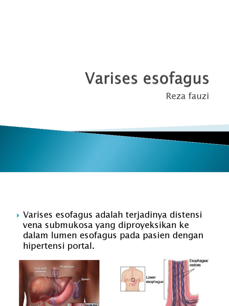 VARISES ESOFAGUS | PDF