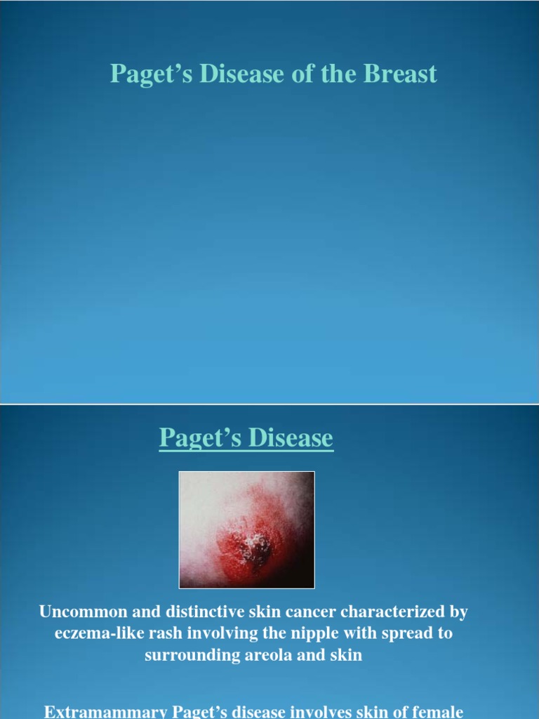 Paget's Disease PP PDF | PDF | Breast Cancer | Neoplasms
