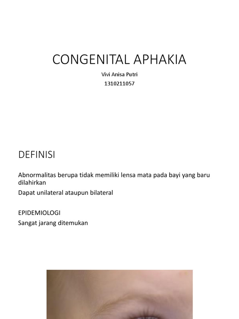 Afakia Kongenital | PDF