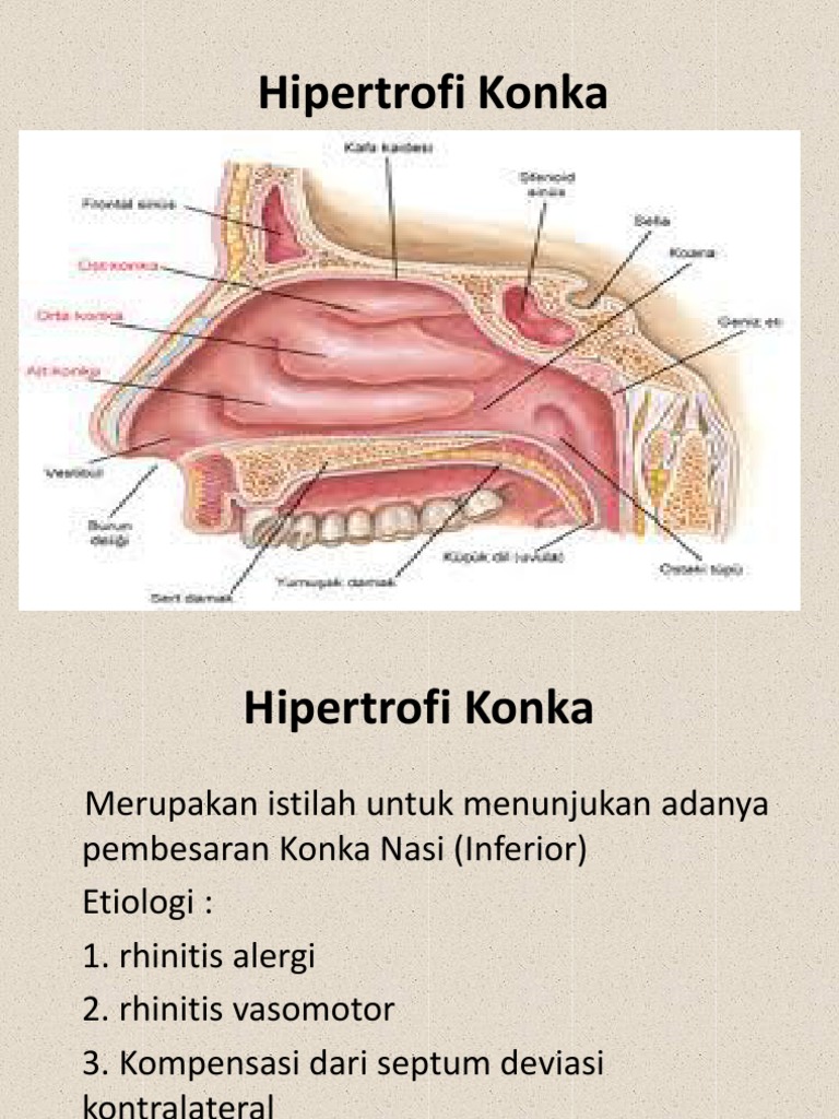Docslide. Hipertrofi-Konka | PDF