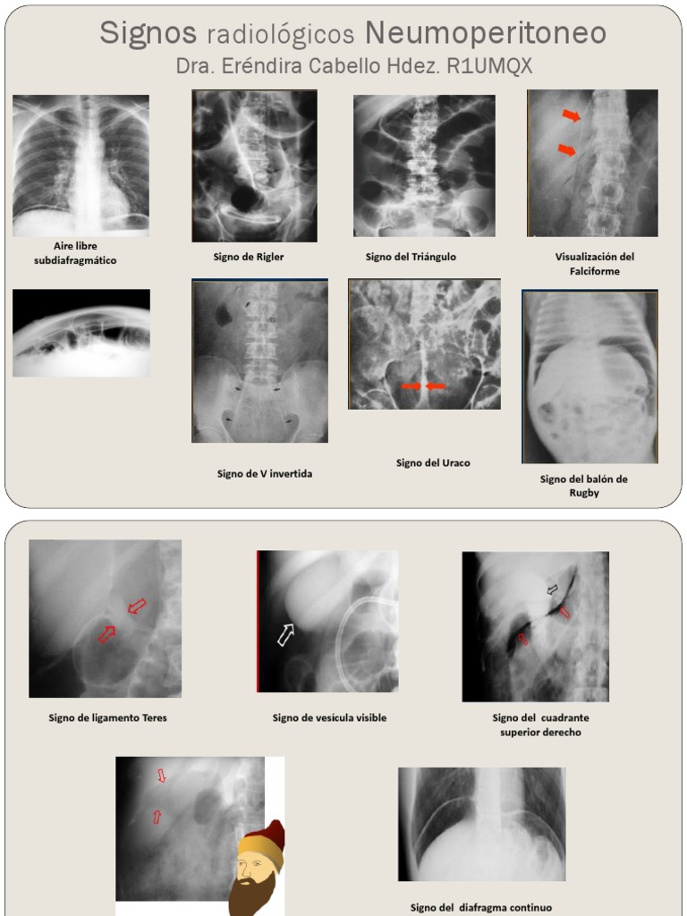 Signos Radiológicos Neumoperitoneo | PDF