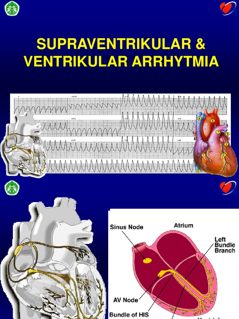 SVT VT MLT | PDF | Electrophysiology | Cardiac Electrophysiology