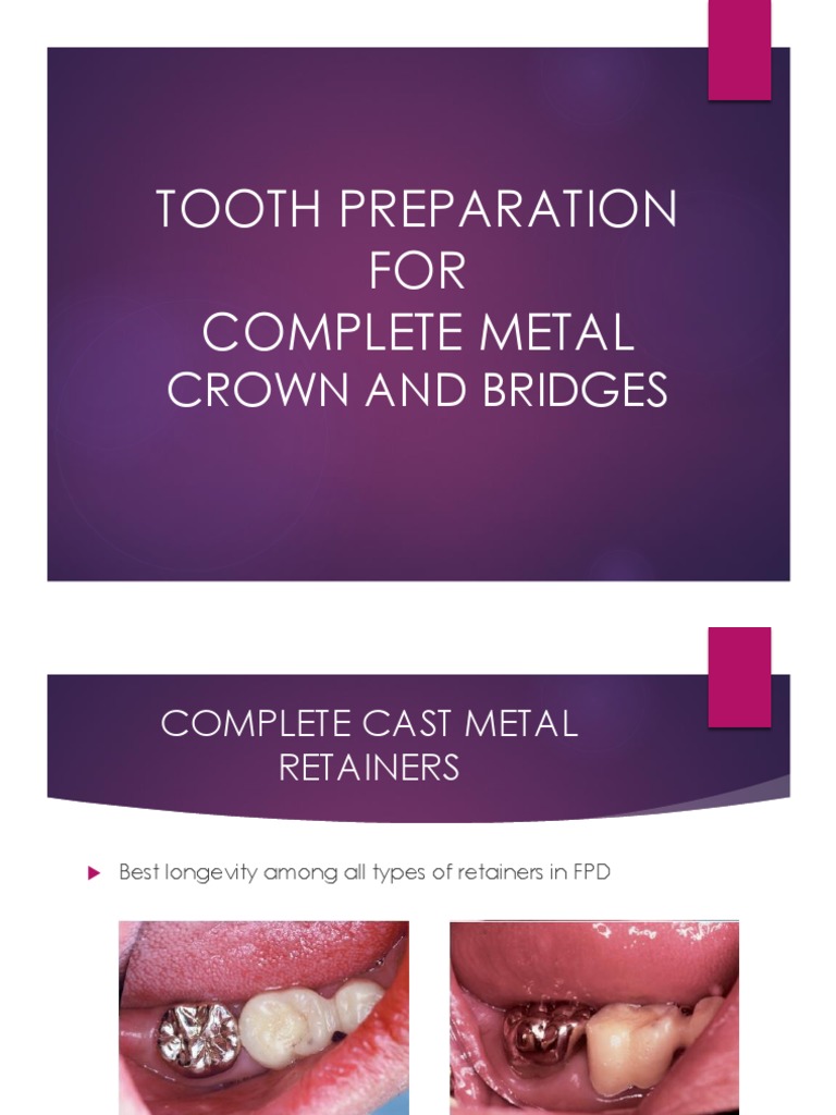 Tooth Preparation For Complete Metal Crowns and Bridges | PDF | Face ...