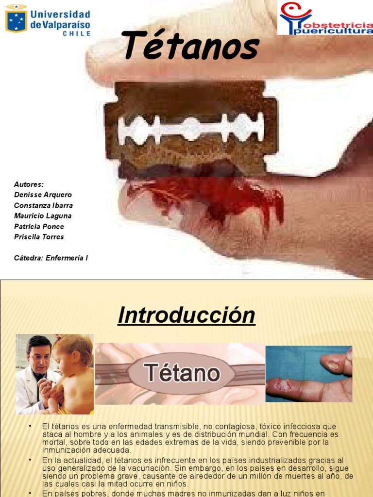 Tétanos | Medicina CLINICA | Enfermedades y trastornos