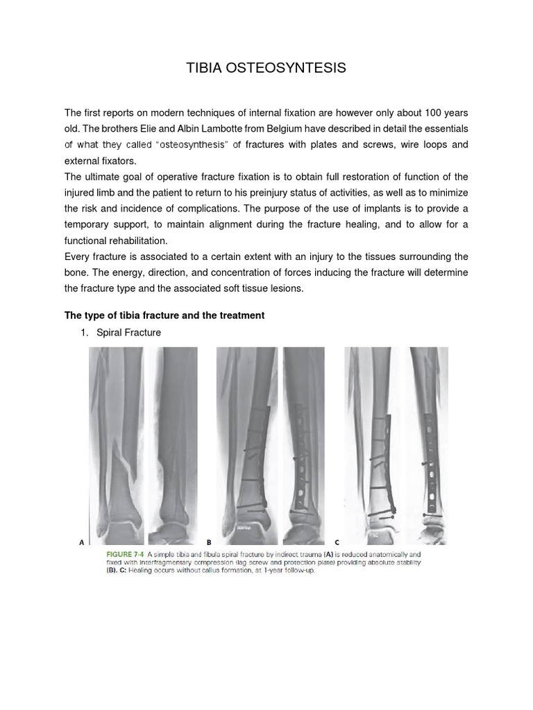 Tibia Osteosyntesis: The Type of Tibia Fracture and The Treatment | PDF ...