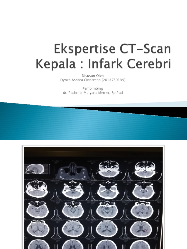 Ekspertise CT-Scan Kepala Stroke Infark | PDF