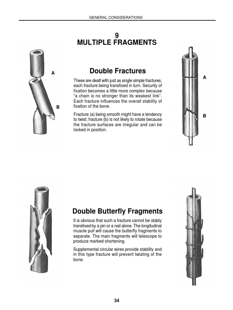 9 Multiple Fragments: General Considerations | PDF | Bone | Wire