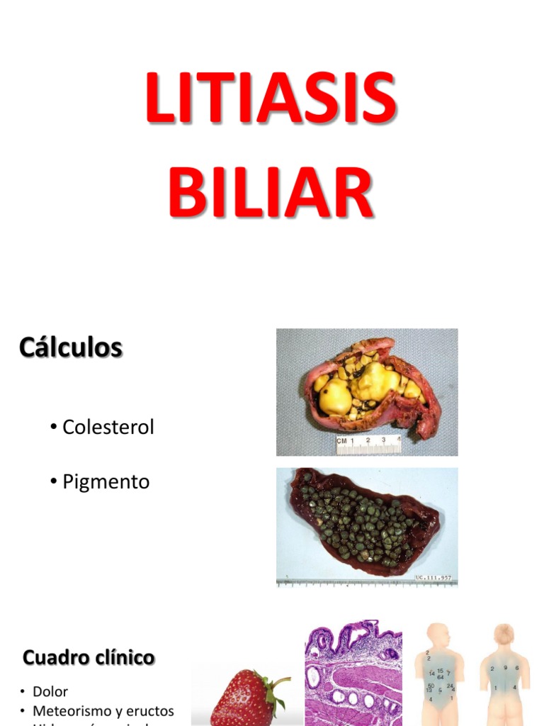 Litiasis Biliar: Síntomas y Diagnóstico | PDF