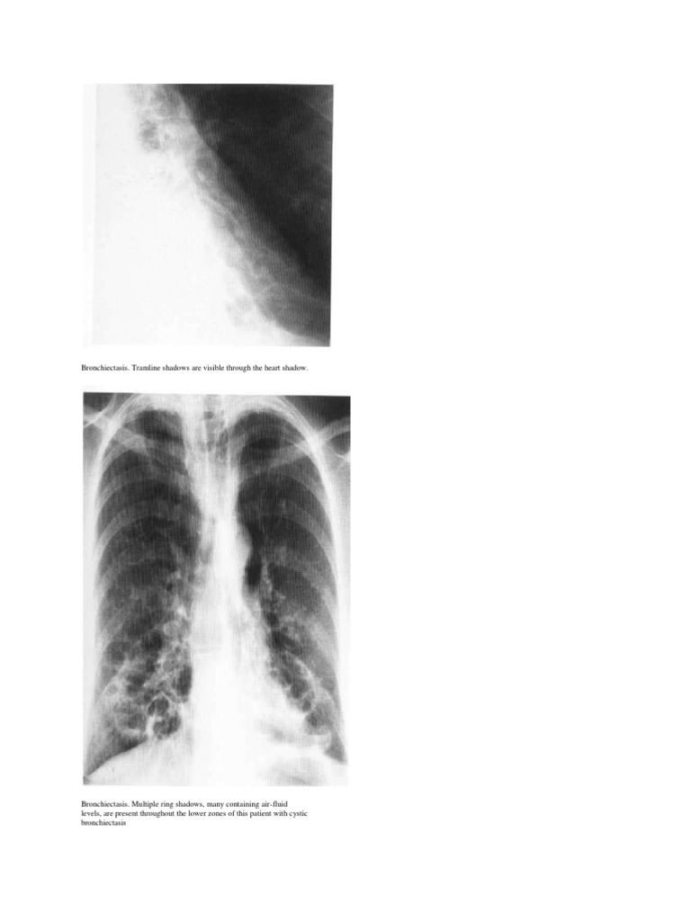 Bronchiectasis. Tramline Shadows Are Visible Through The Heart Shadow | PDF