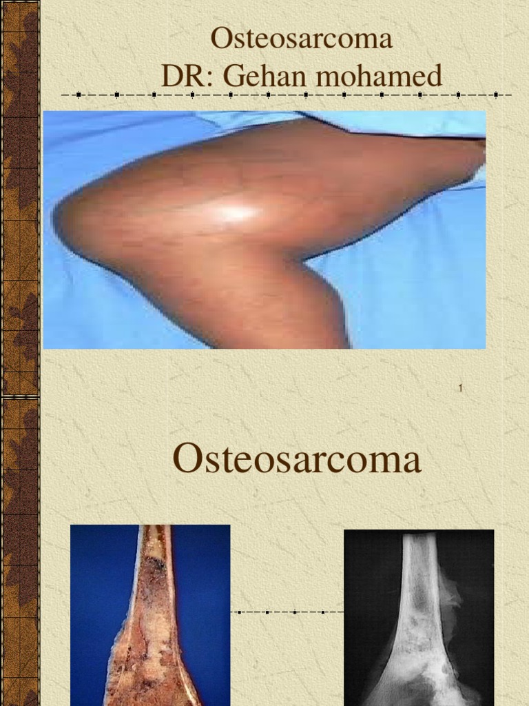 An Overview of Osteosarcoma: Definition, Epidemiology, Risk Factors ...