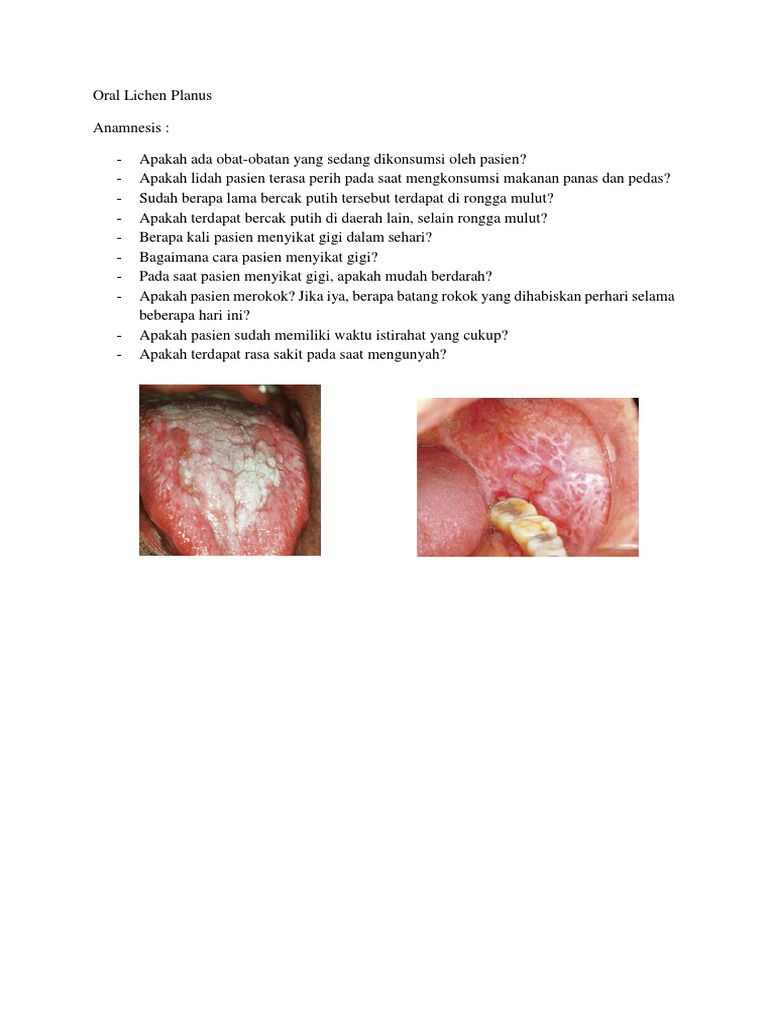 Pengobatan dan Gejala Lichen Planus Oral | PDF | Kesehatan Holistik