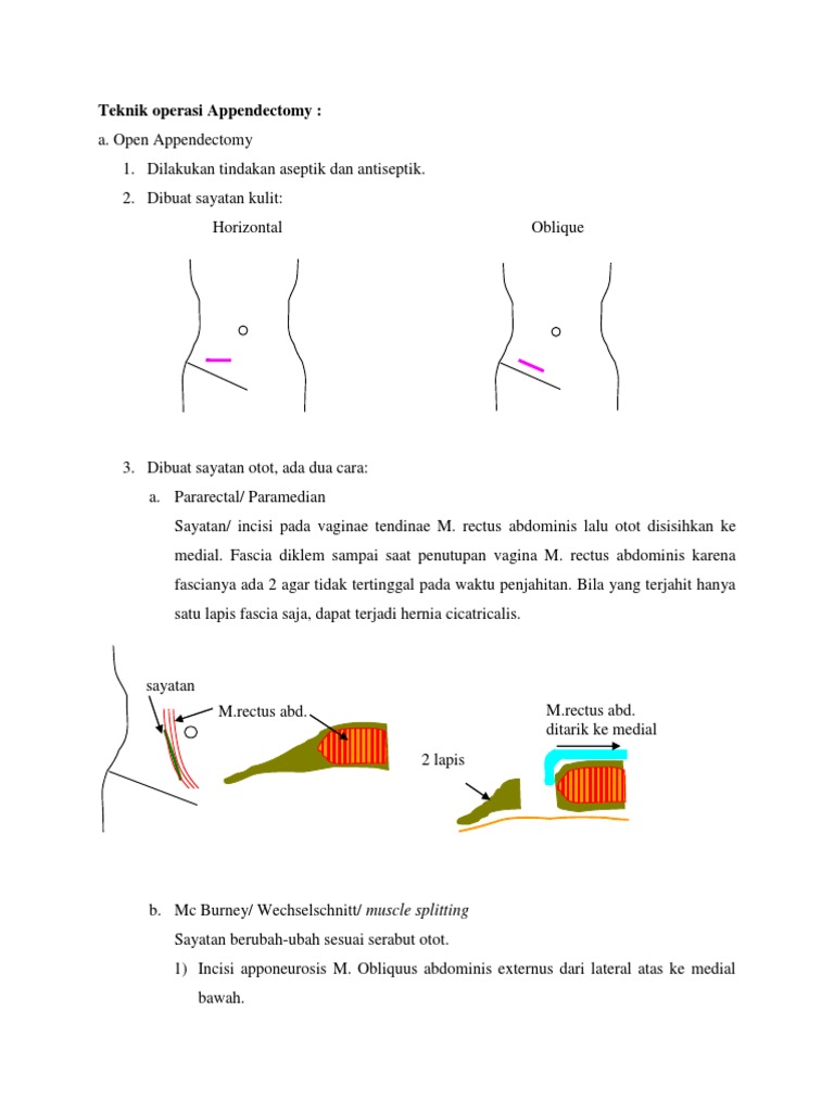 Teknik Operasi Appendectomy | PDF