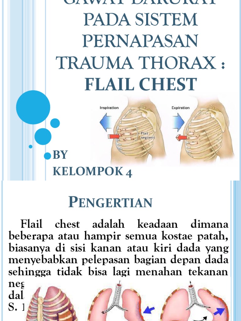 Flail Chest | PDF