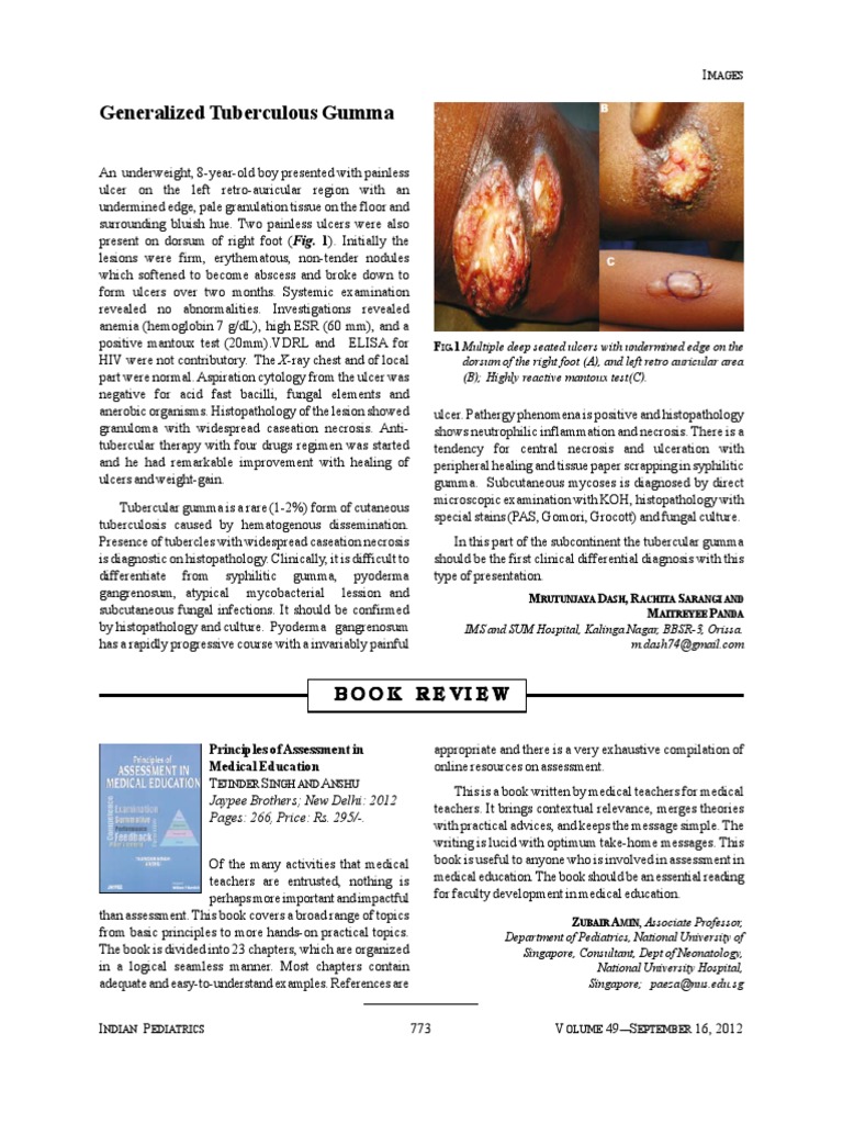 Tubercular Gumma in Pediatric Patient | PDF | Tuberculosis | Immunology