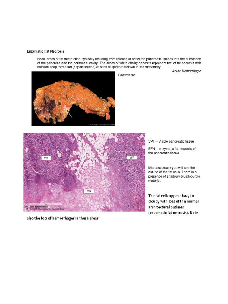 Enzymatic Fat Destruction in Acute Pancreatitis: Microscopic Findings ...