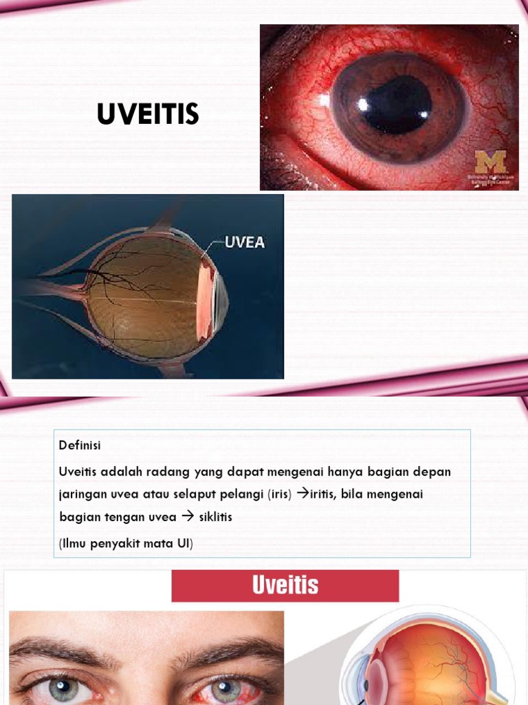 Uveitis | PDF | Kesehatan Holistik