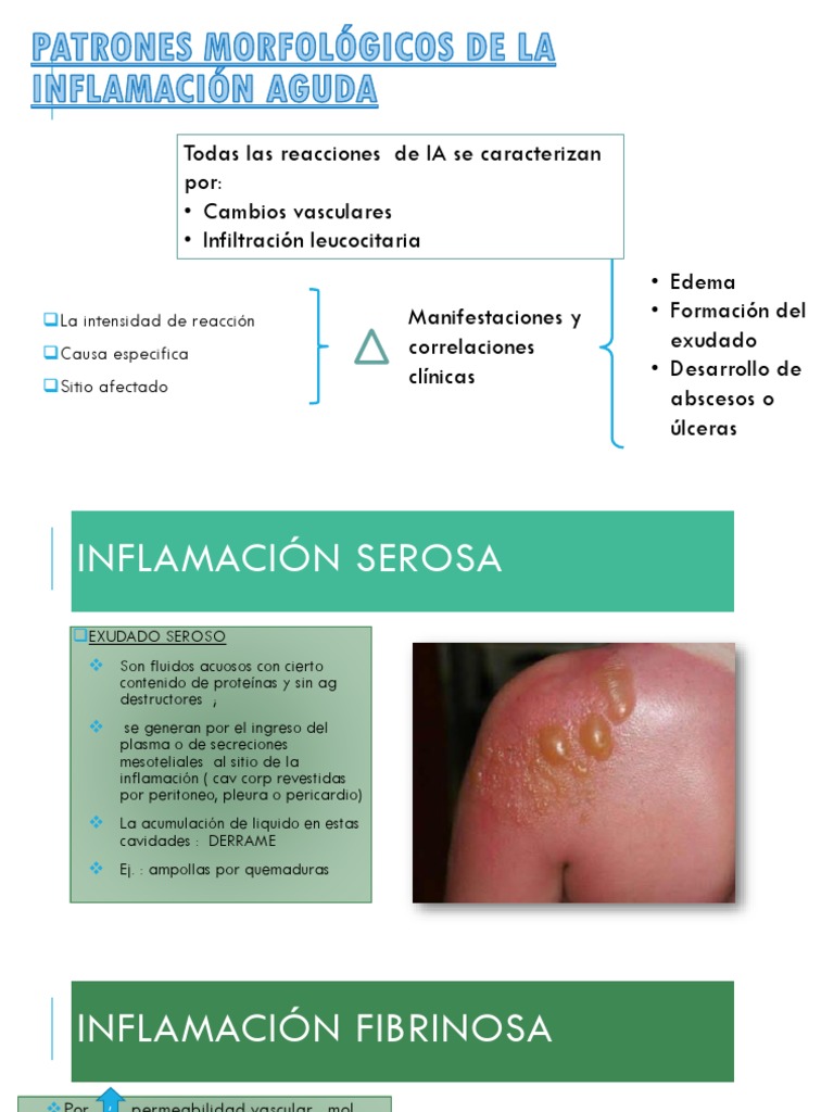 PATRONES MORFOLÓGICOS DE LA INFLAMACIÓN AGUDA.pptx | Inflamación | Medicina