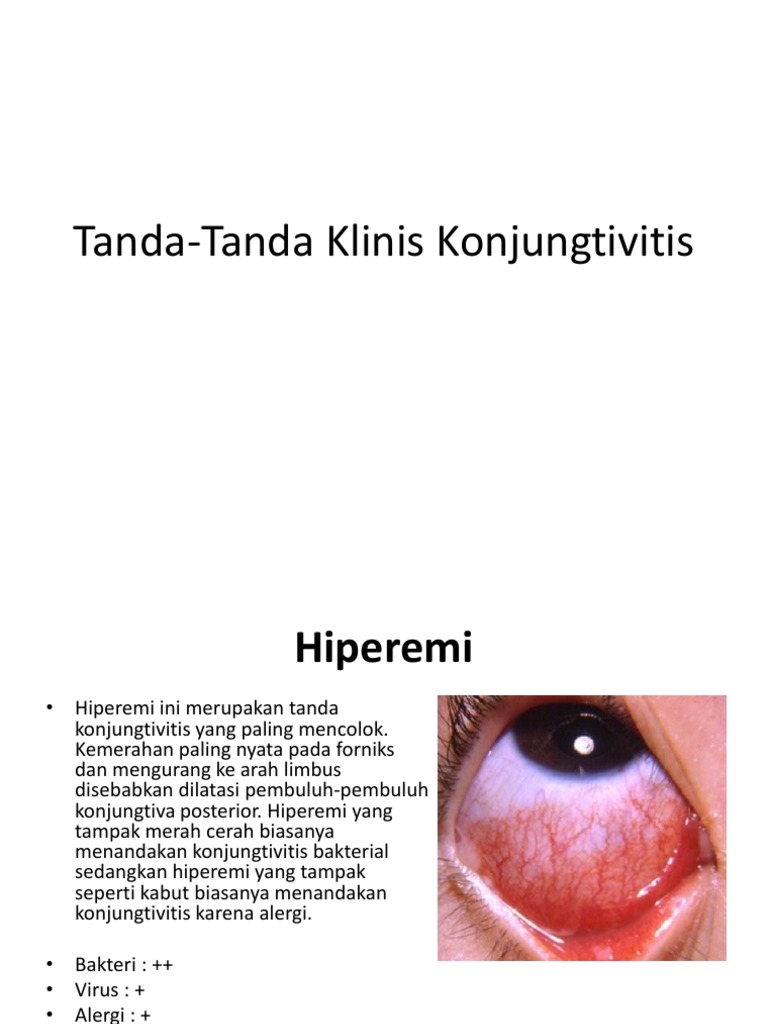 Tanda Klinis Konjungtivitis Hiperemi | PDF