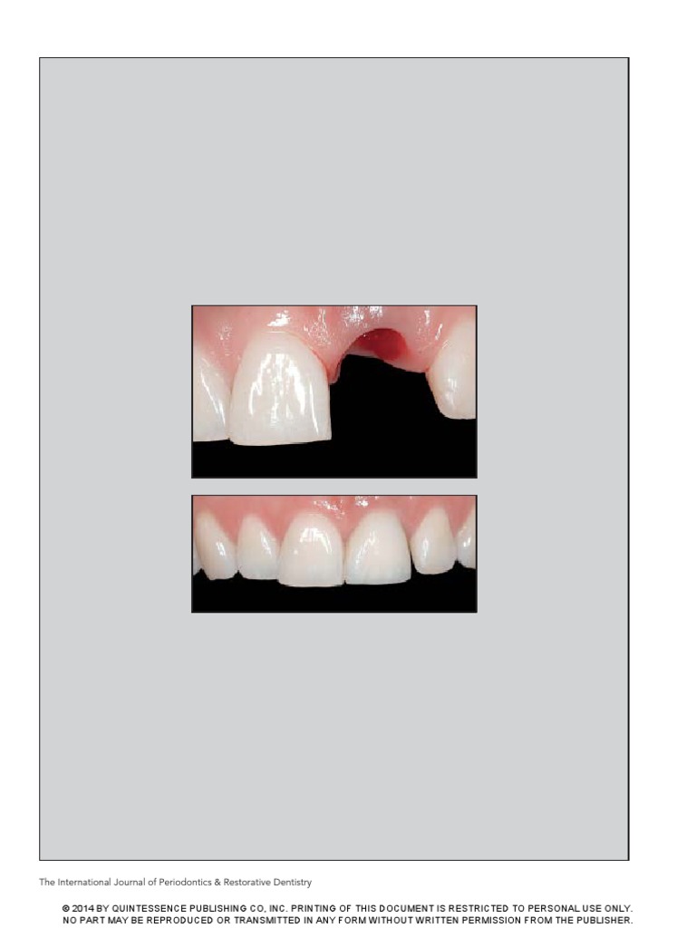Emergence Profile Based IOI Position | PDF | Dental Implant ...